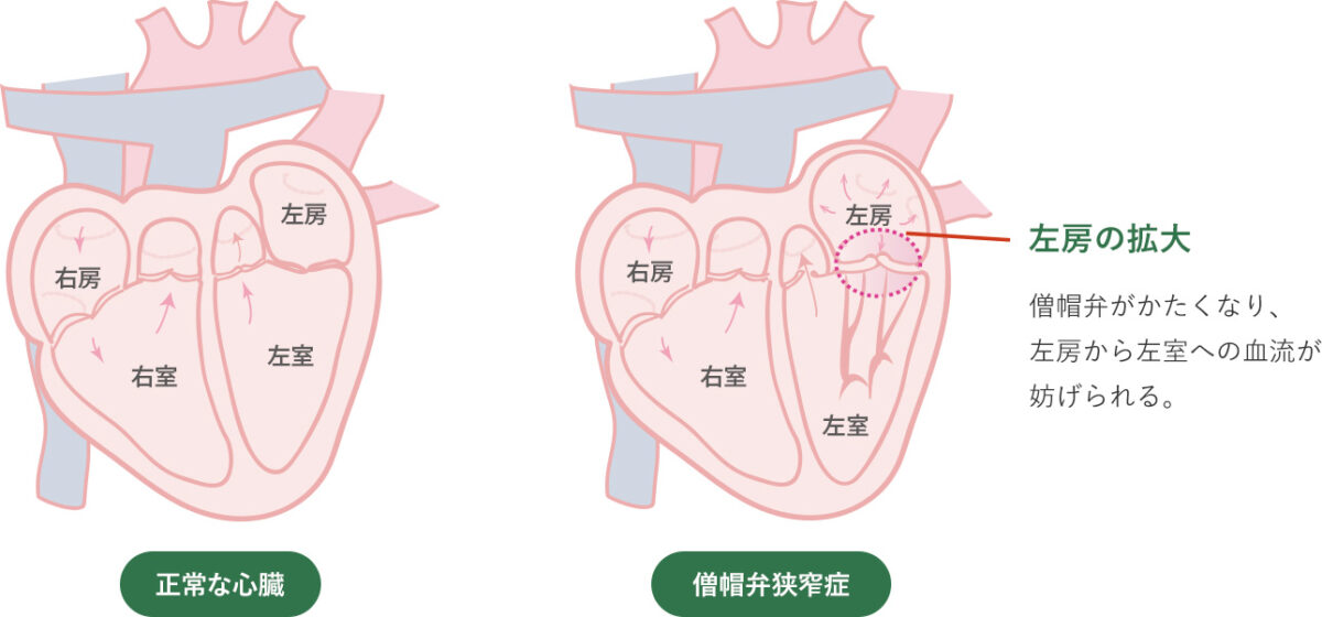 経皮経静脈的僧帽弁交連切開術（PTMC） – 岐阜ハートセンター