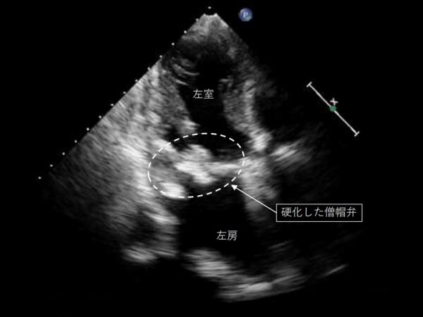 経皮経静脈的僧帽弁交連切開術（PTMC） – 岐阜ハートセンター