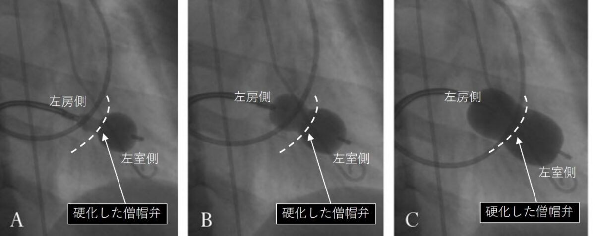 経皮経静脈的僧帽弁交連切開術（PTMC） – 岐阜ハートセンター